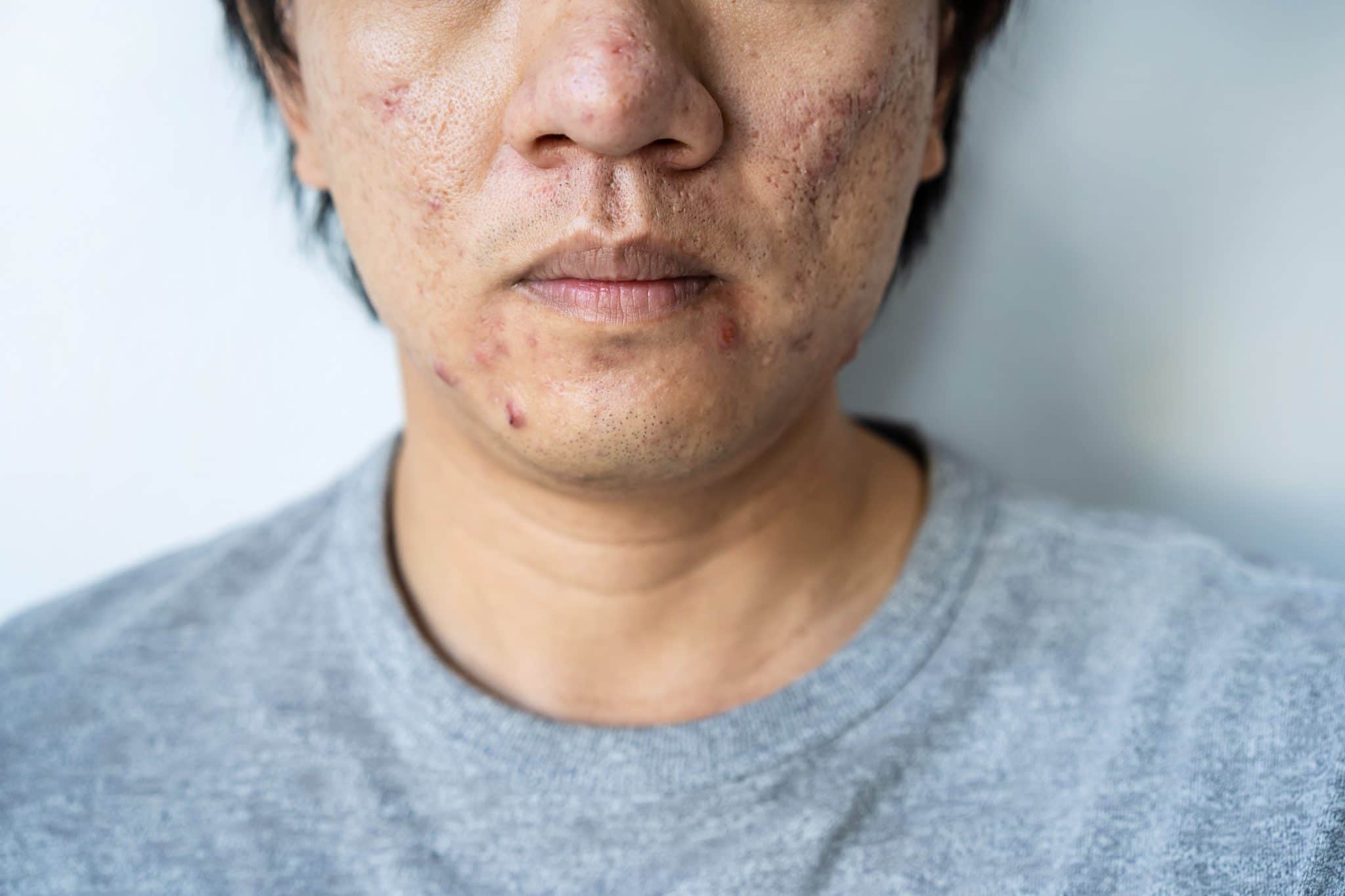 Things You Need to Know About Acne Scar Removal in Singapore | SL ...