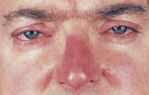 The Four Types of Rosacea – All About it | SL Aesthetic Clinic