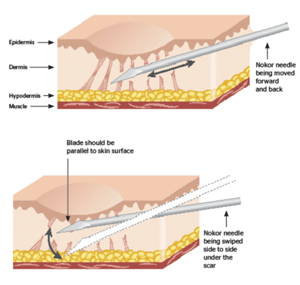 Acne Scar Treatment & Removal in Singapore | SL Aesthetic Clinic