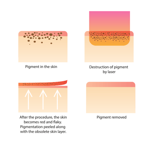 Skin Issues Pico Laser Skin Rejuvenation Can Treat