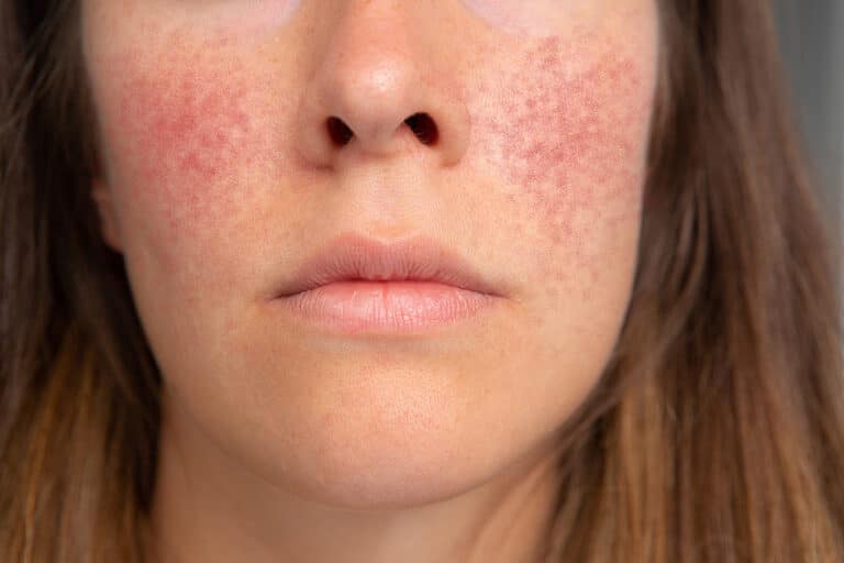 Identifying Mild Rosacea and Seeking Treatment - SL Aesthetic Clinic