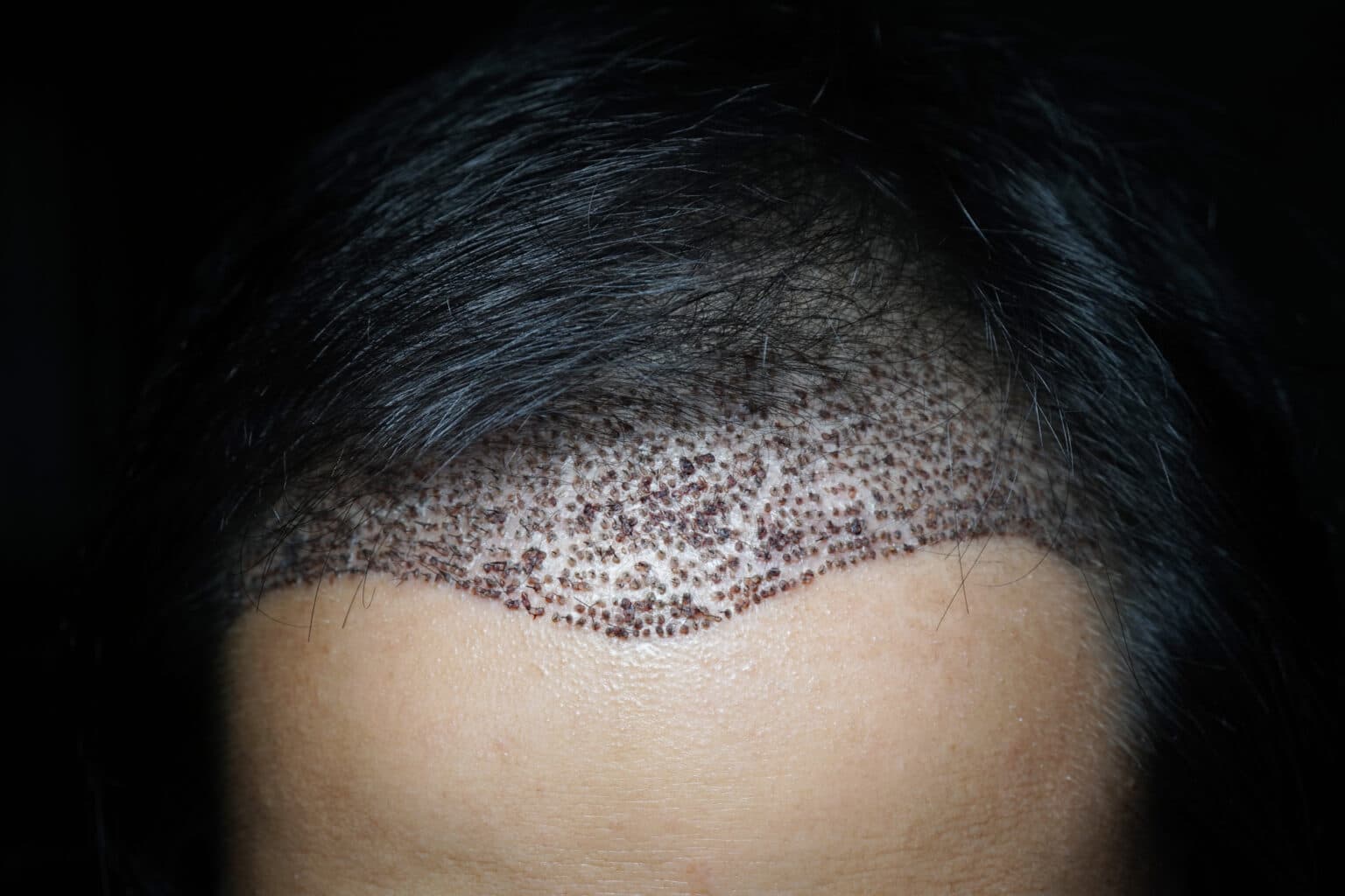 FUE Hair Transplant: Timeline and Patient Journey - SL Aesthetic Clinic