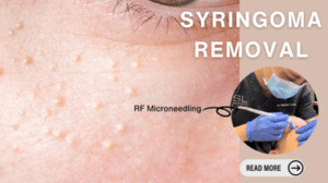Microneedling, Lasers & Creams - Syringoma Removal Options